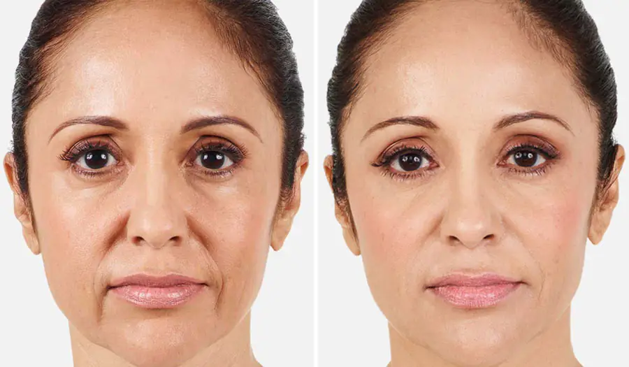 Mini Facelift vs Facelift: Key Differences Explained - Memphis ...